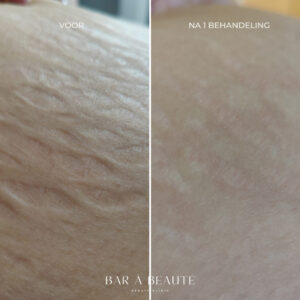 Littekens behandelen I Bar à Beauté Beauty Clinic