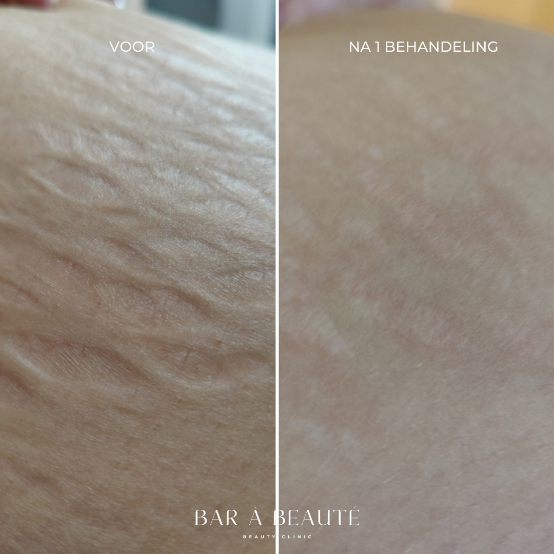 Littekens behandelen I Bar à Beauté Beauty Clinic